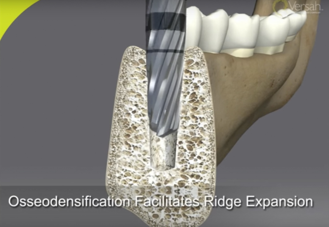 Osseodensification, changing osteotomies - Dentistry.co.uk