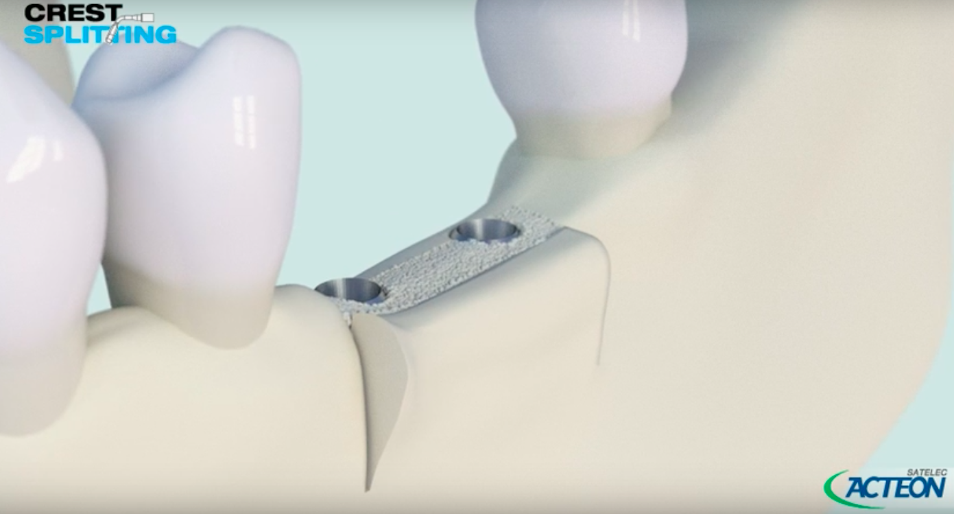 How to deal with a thin crest - Dentistry.co.uk