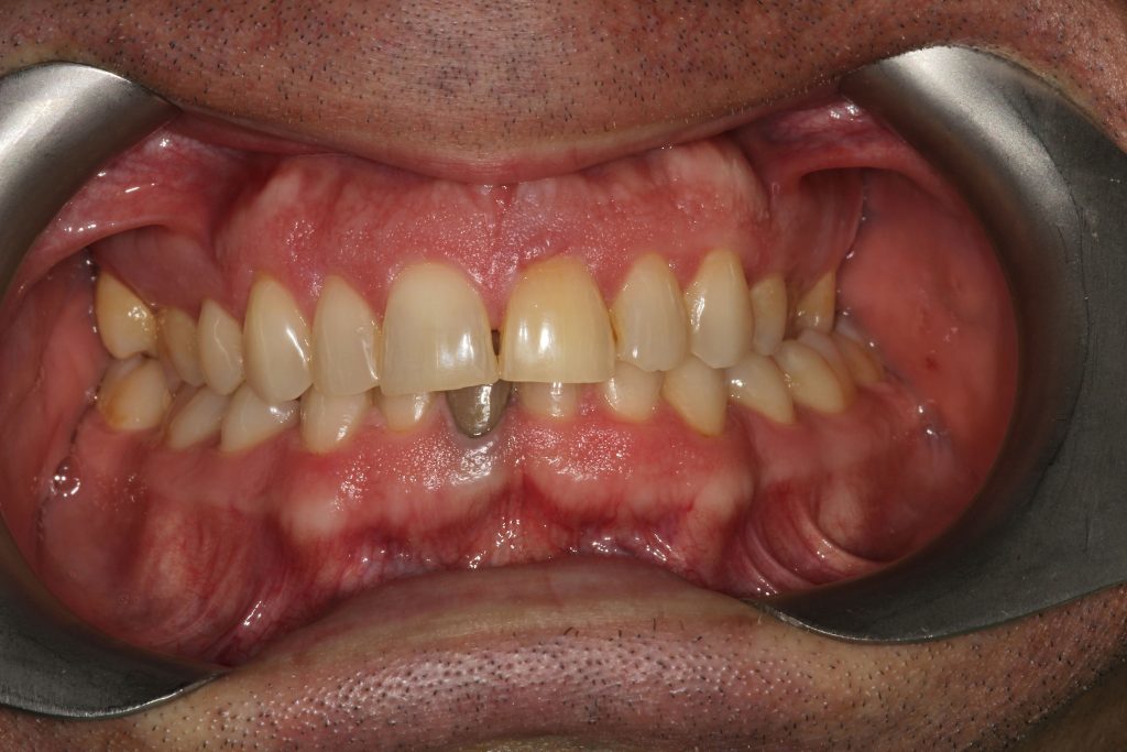 Non-vital bleaching of a dark tooth in the aesthetic zone - Dentistry.co.uk