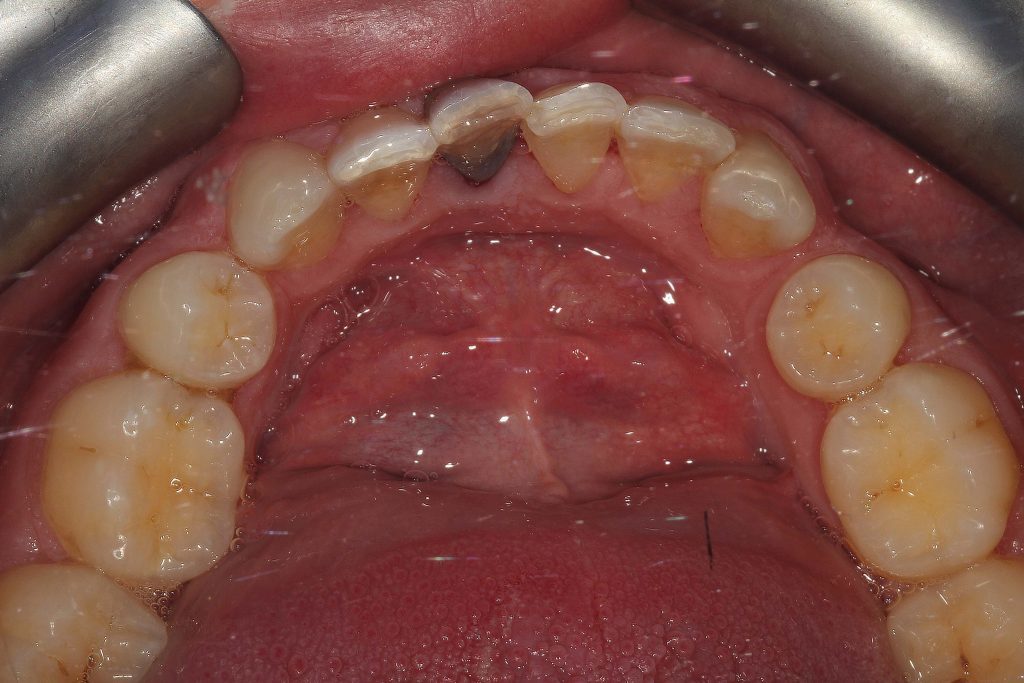 Non-vital bleaching of a dark tooth in the aesthetic zone - Dentistry.co.uk