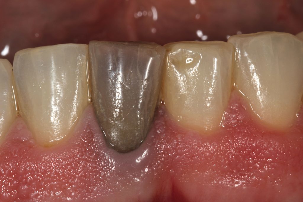 Non-vital bleaching of a dark tooth in the aesthetic zone - Dentistry.co.uk