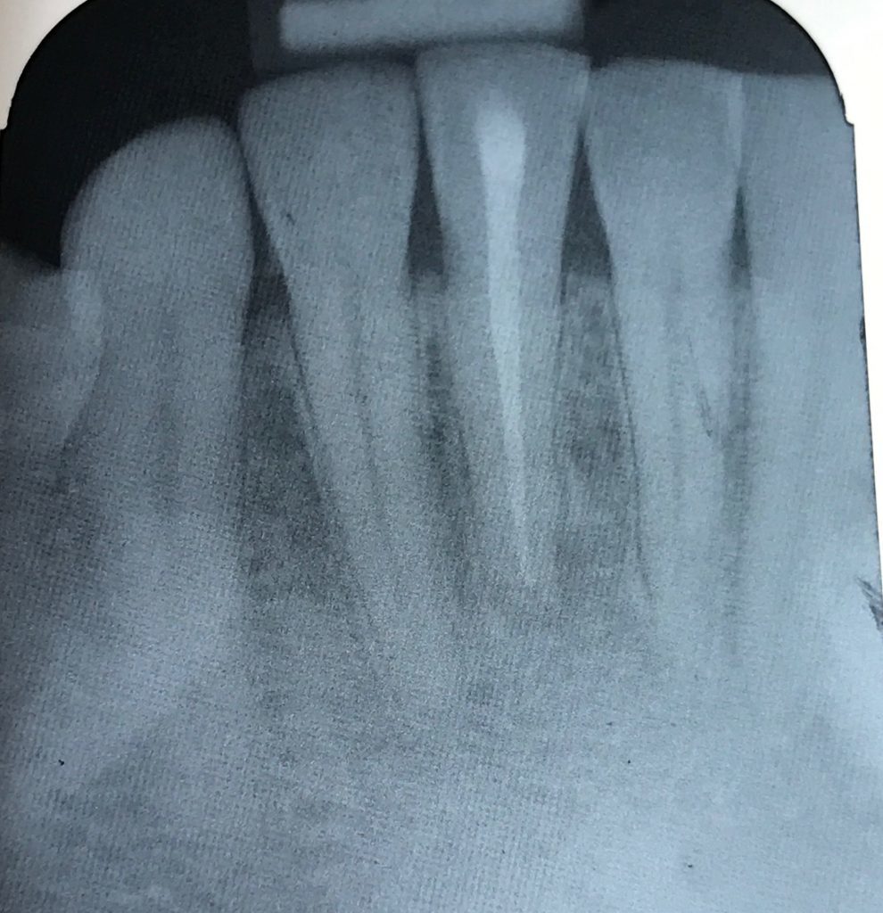 Non-vital bleaching of a dark tooth in the aesthetic zone - Dentistry.co.uk