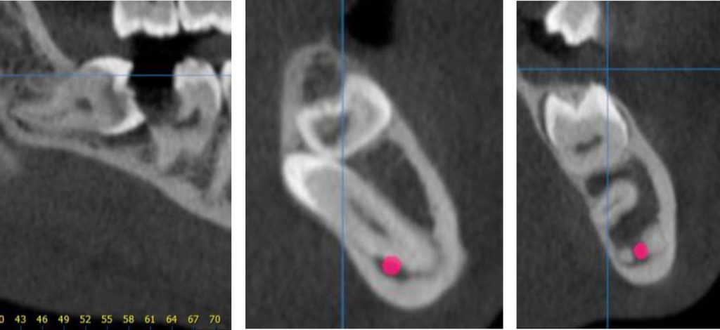 Case of the month – impacted teeth - Dentistry.co.uk