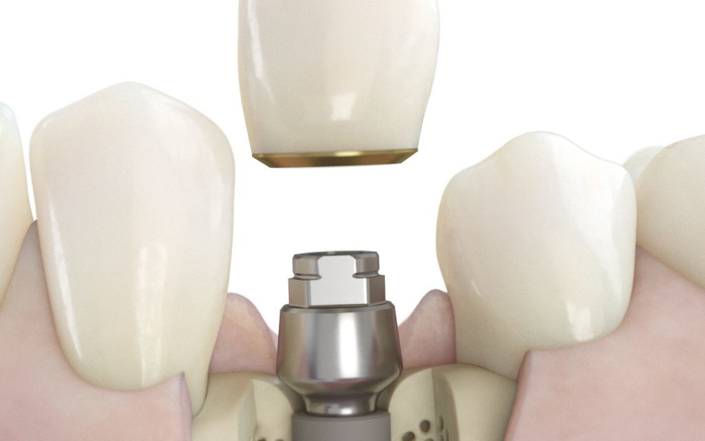 No screw, no glue – a prosthodontic dream come true! - Dentistry.co.uk