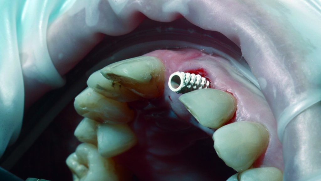 Immediate implant loading: aesthetics and functionality - Dentistry.co.uk
