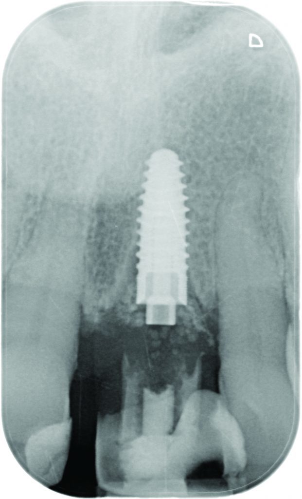 Immediate implant loading: aesthetics and functionality - Dentistry.co.uk