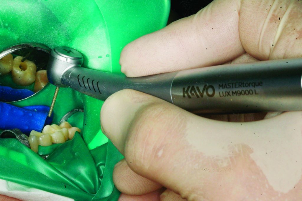 Complex endodontic situations simply managed – from adhesive composite build-up to successful ...