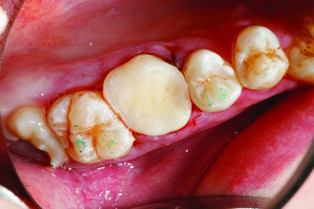Complex endodontic situations simply managed – from adhesive composite ...
