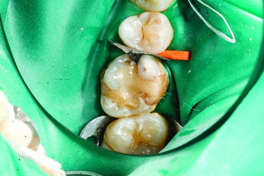 Complex endodontic situations simply managed – from adhesive composite ...