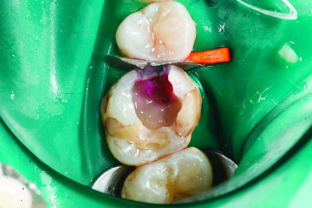 Complex endodontic situations simply managed – from adhesive composite ...
