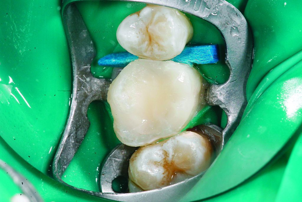 Complex endodontic situations simply managed – from adhesive composite ...
