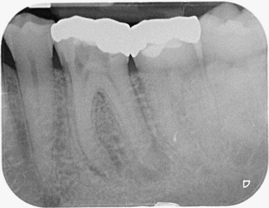 Complex endodontic situations simply managed – from adhesive composite ...