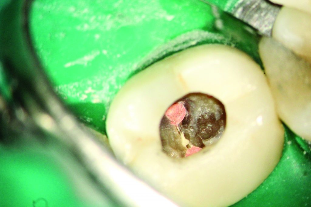 Complex endodontic situations simply managed – from adhesive composite build-up to successful ...