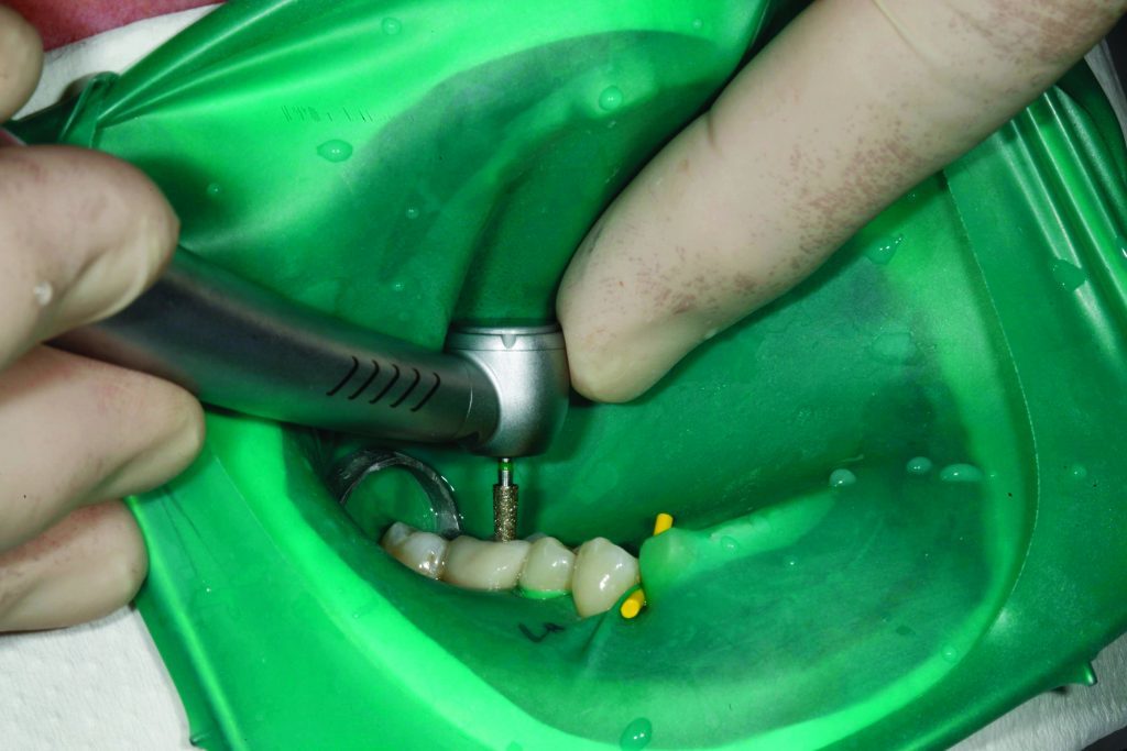 Complex endodontic situations simply managed – from adhesive composite build-up to successful ...