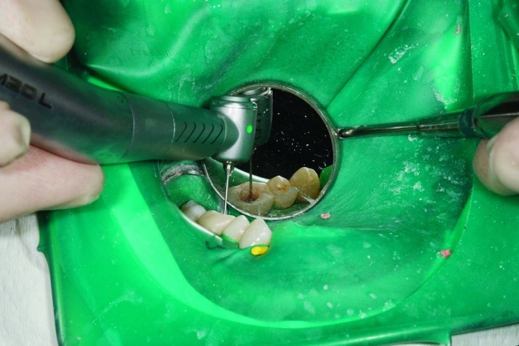 Complex endodontic situations simply managed – from adhesive composite build-up to successful ...