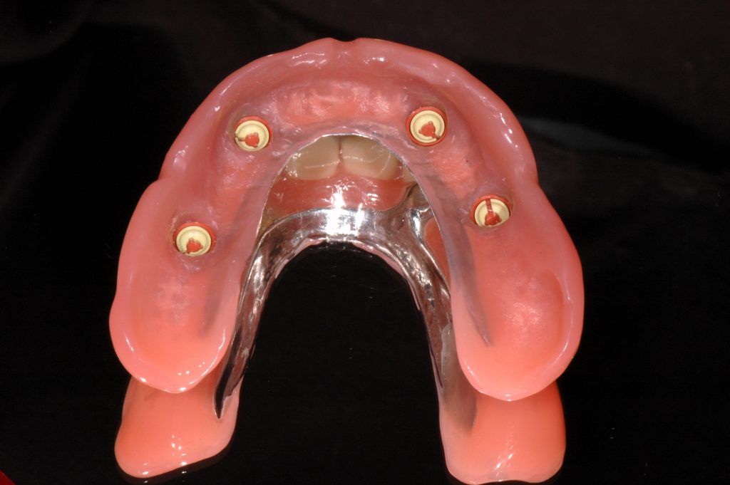 Instructions for use: CM Loc Flex implants - Dentistry.co.uk