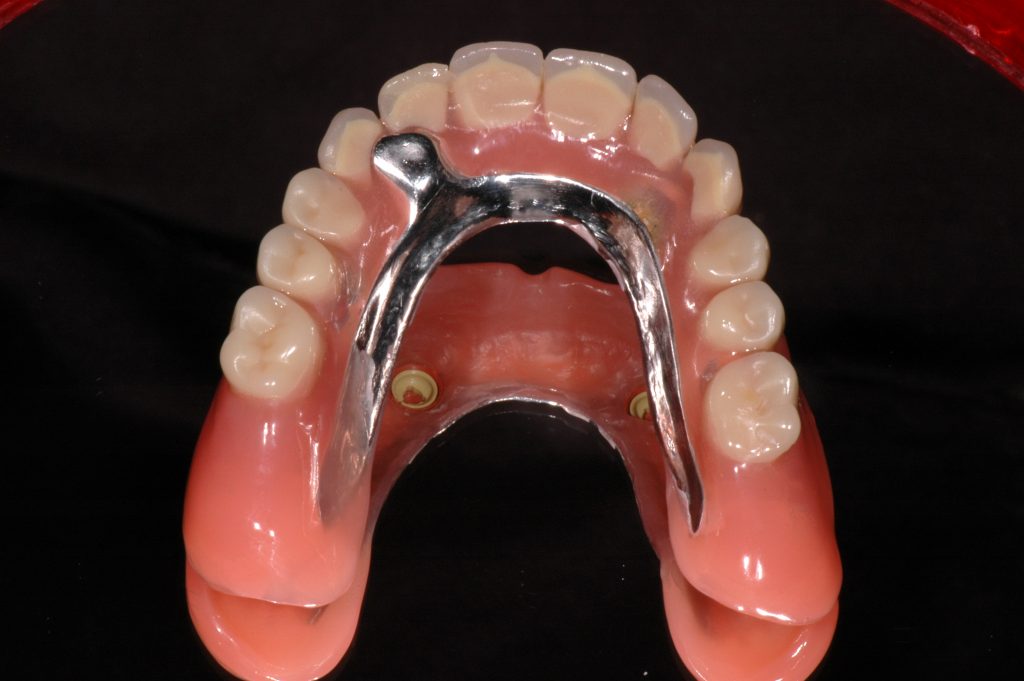 Instructions for use: CM Loc Flex implants - Dentistry.co.uk