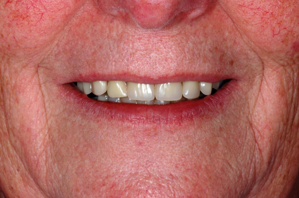 Instructions for use: CM Loc Flex implants - Dentistry.co.uk