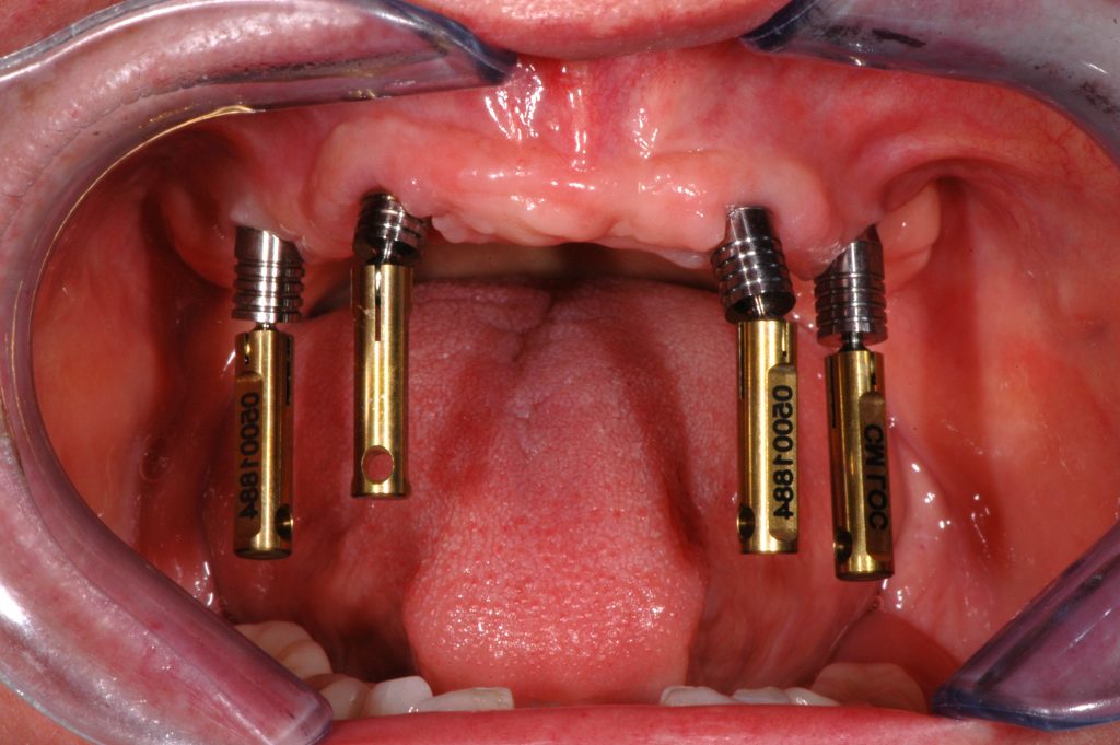 Instructions for use: CM Loc Flex implants - Dentistry.co.uk