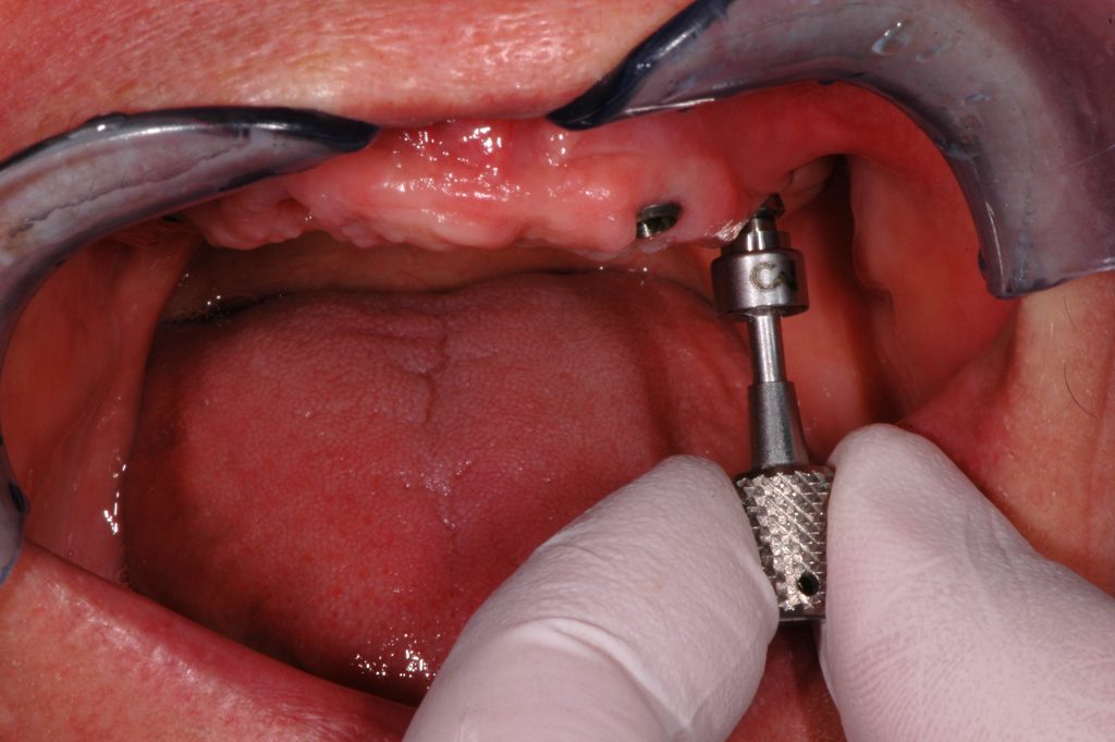 Instructions for use: CM Loc Flex implants - Dentistry.co.uk