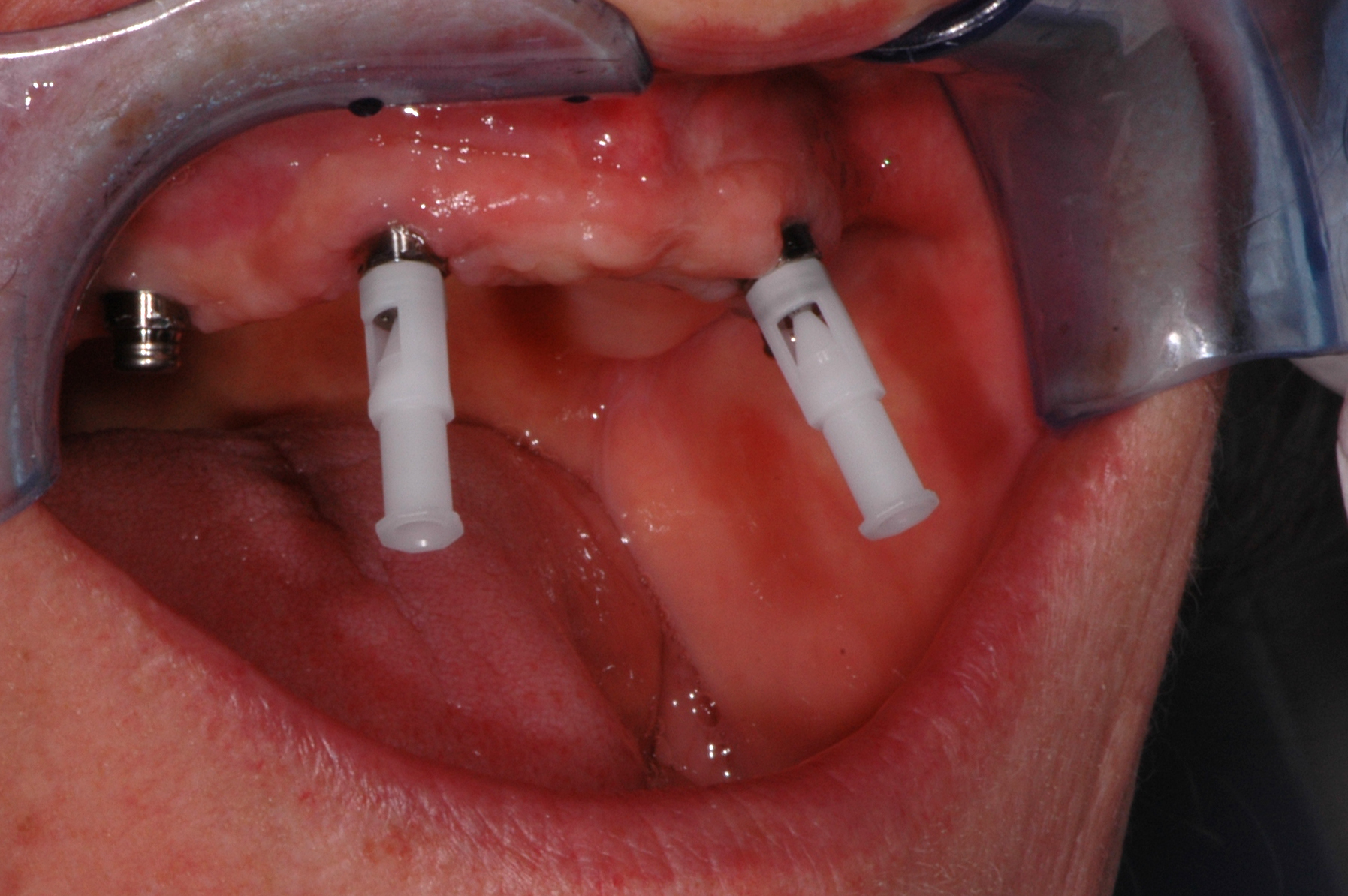 Instructions for use: CM Loc Flex implants - Dentistry.co.uk