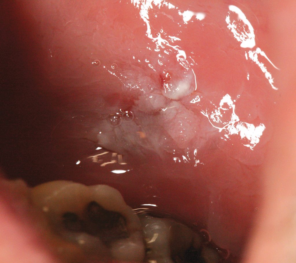 Early detection of mouth cancer – improving success - Dentistry.co.uk