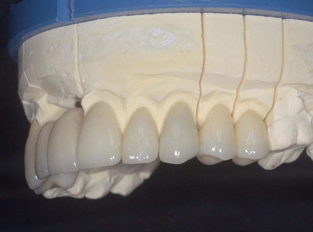 E.max to solve a complex upper anterior restorative case – Dentistry.co.uk