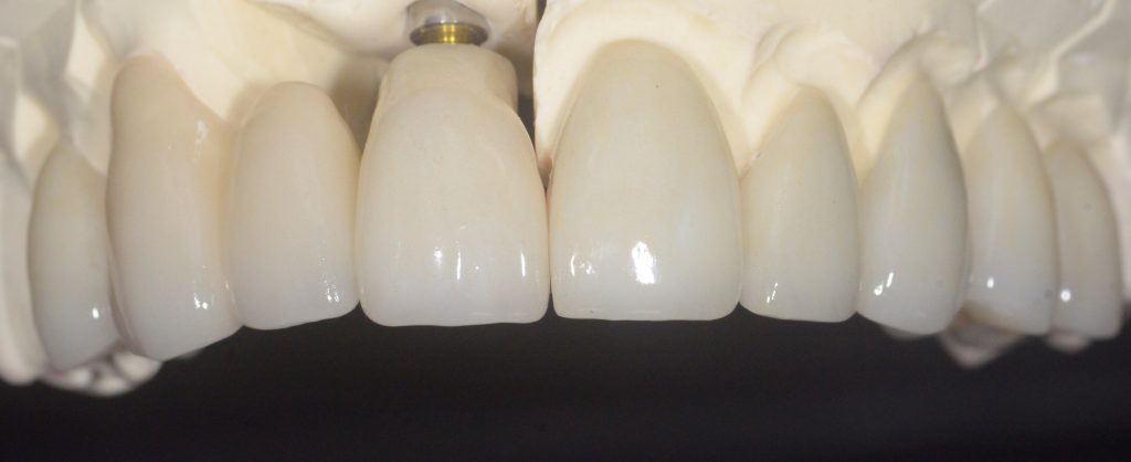 E.max to solve a complex upper anterior restorative case – Dentistry.co.uk