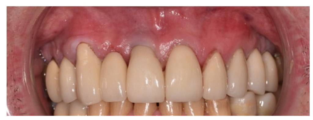 E.max to solve a complex upper anterior restorative case – Dentistry.co.uk