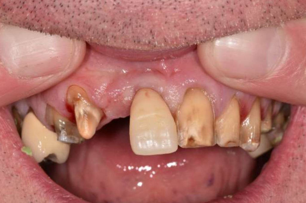 E.max to solve a complex upper anterior restorative case – Dentistry.co.uk