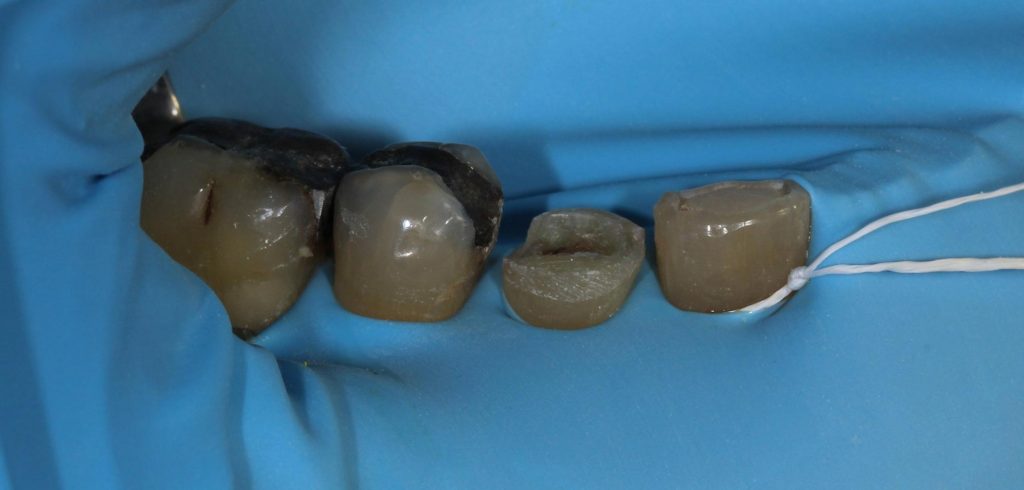 Increase cuspal restoration options with One Visit Crown – Dentistry.co.uk