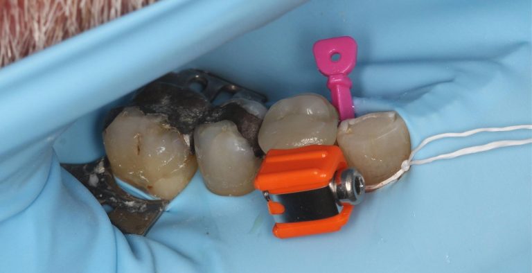 Increase cuspal restoration options with One Visit Crown – Dentistry.co.uk