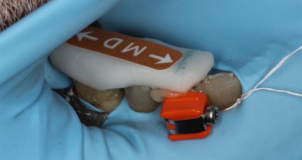 Increase cuspal restoration options with One Visit Crown – Dentistry.co.uk