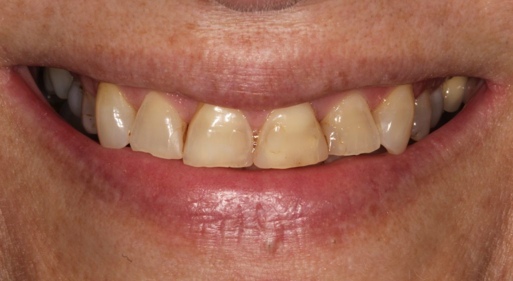 Improving anterior teeth with ultra-translucent zirconia – Dentistry.co.uk