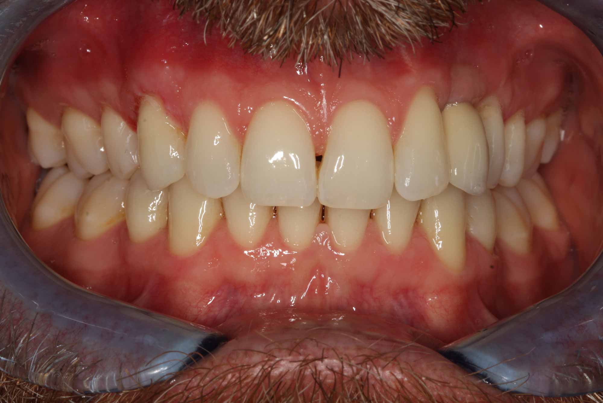 front-tooth-DE8 - Dentistry.co.uk