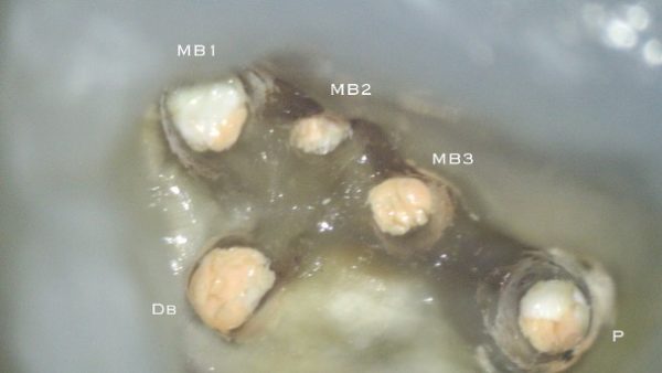 The root to success – tips for locating the MB2 – Dentistry Online