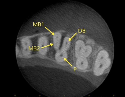The root to success – tips for locating the MB2 – Dentistry Online