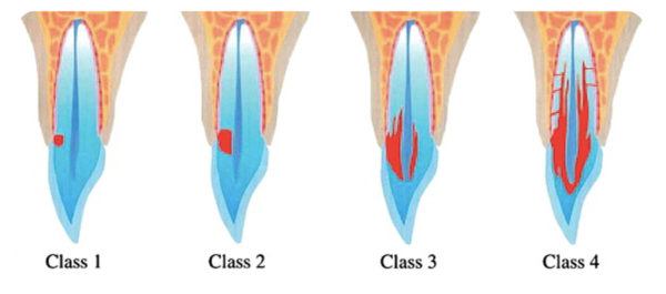 The root of the problem – external cervical resorption – Dentistry Online