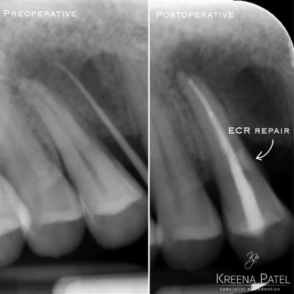 The root of the problem – external cervical resorption – Dentistry Online