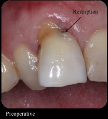 The root of the problem – external cervical resorption – Dentistry Online