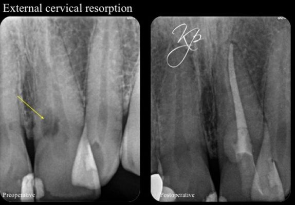 The root of the problem – external cervical resorption – Dentistry Online