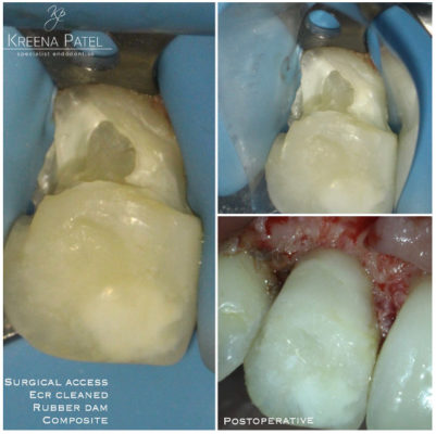 The root of the problem – external cervical resorption – Dentistry Online