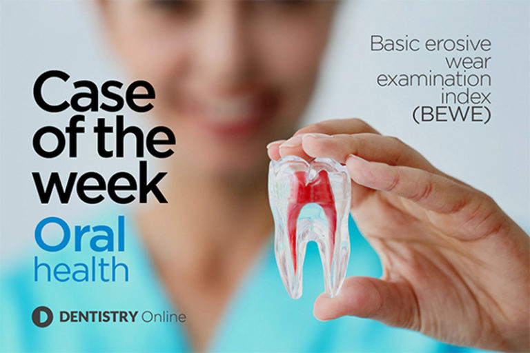 Case of the week guidelines for dentists using the BEWE - Dentistry Online