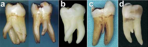 The endo expert – the radix – Dentistry Online