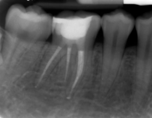 The endo expert – the radix – Dentistry Online