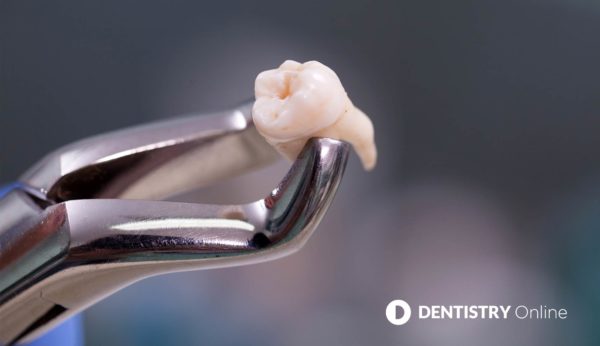 More babies being born without wisdom teeth – Dentistry Online