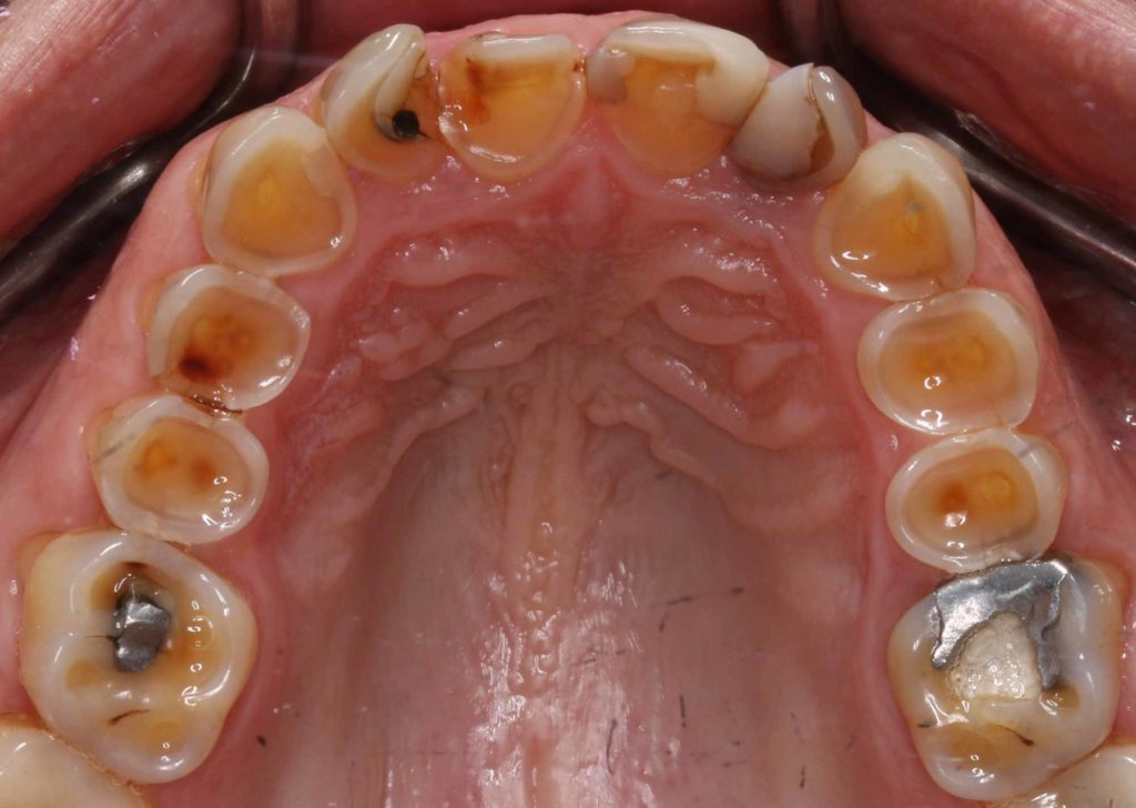 Prosthodontips – diagnosing and treating toothwear – Dentistry Online
