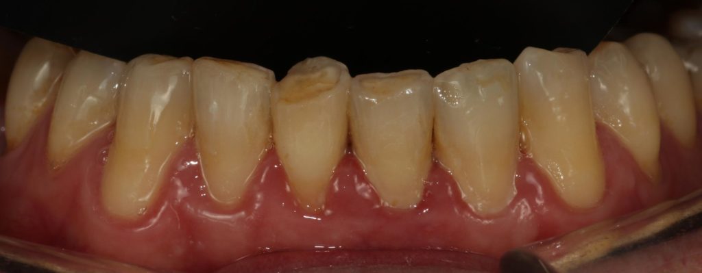 Prosthodontips – diagnosing and treating toothwear – Dentistry Online