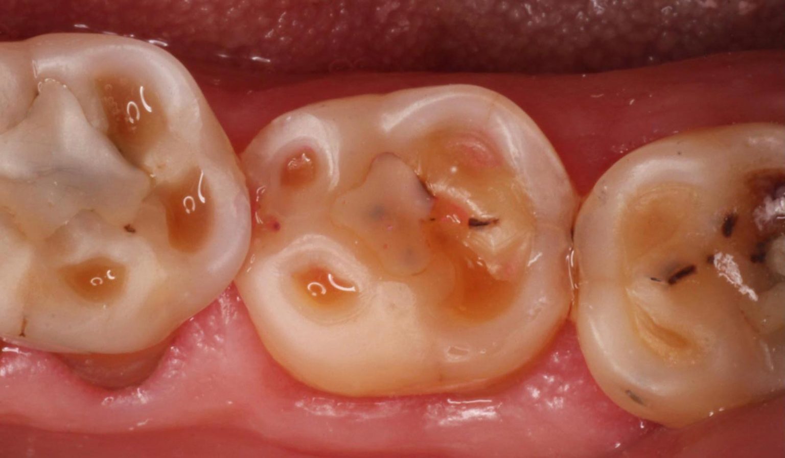 Prosthodontips – diagnosing and treating toothwear – Dentistry Online