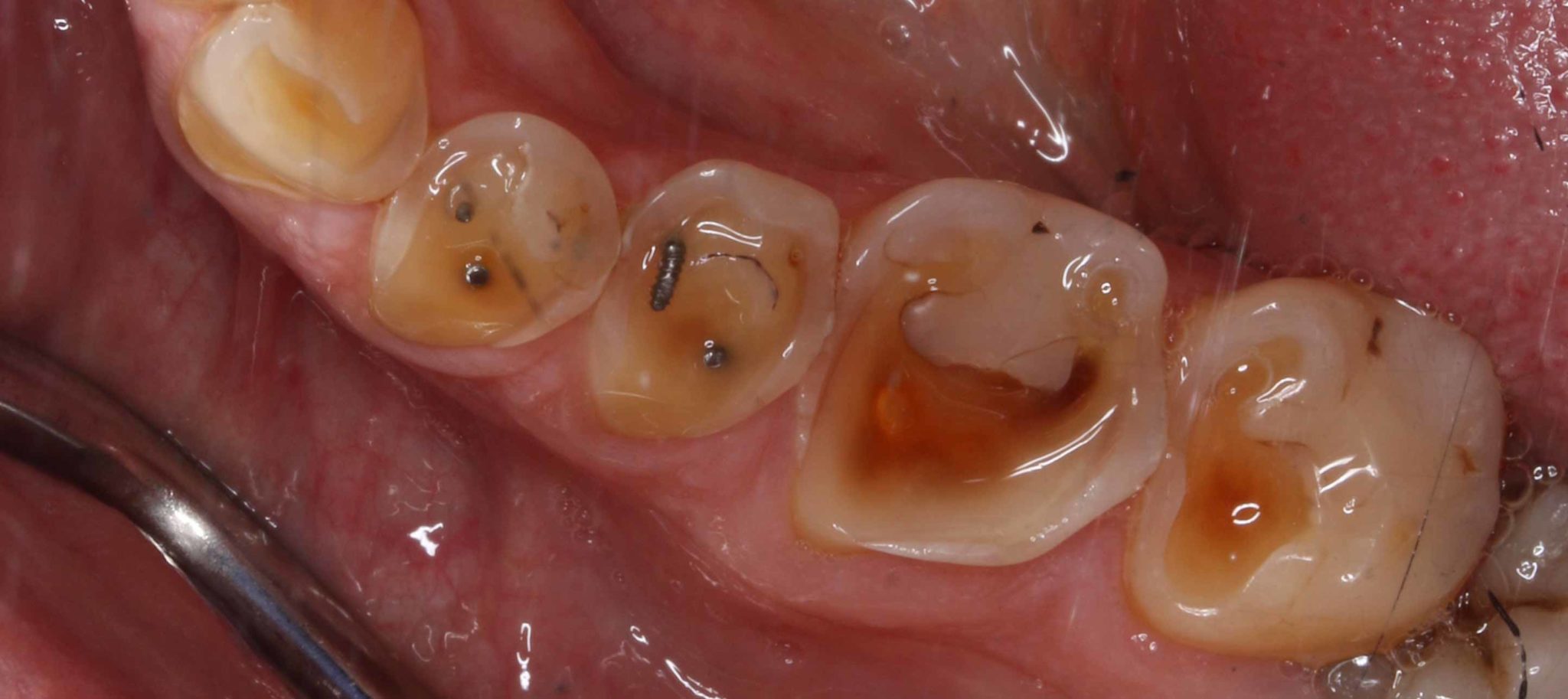 Prosthodontips – managing toothwear – Dentistry Online
